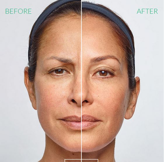 Dysport Mill Valley | Dysport Injections San Francisco